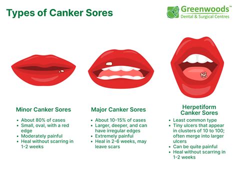 Canker Sore Treatment And Causes Greenwoods Dental Blog