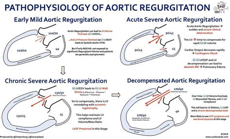 Pathophysiology Of Aortic Regurgitation Perfusfind