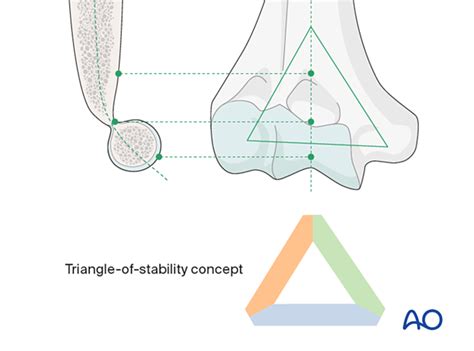 Splint Immobilization For Avulsion Of Lateral Epicondyle