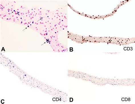 Cell Block Preparation From Csf Cytology And Limited Panel Of