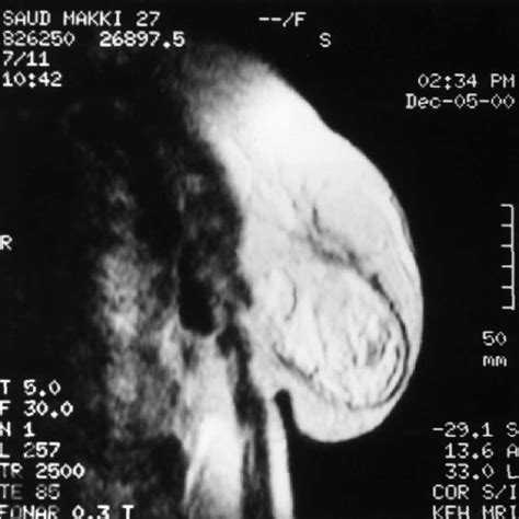Mri Using A T2 Spin Echo Sequence The Mass Shows High Signal
