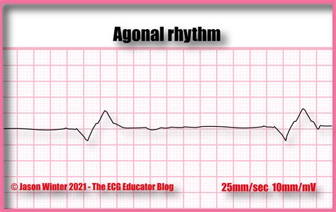 The Ecg Educator And Mentor Blog Agonal Rhythm