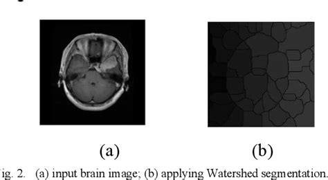 Figure 2 From Brain Tumor Classification Using Watershed Segmentation