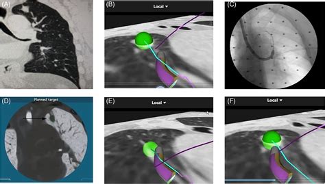 Improved Diagnostic Yield For Lung Nodules With Digital Tomosynthesis‐corrected Navigational