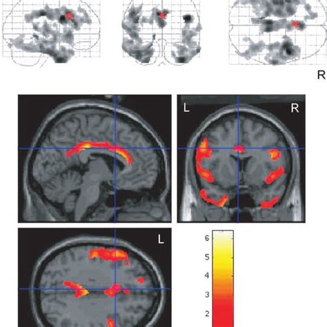 Statistical Parametric Map Displayed On The Generic ‘glass Brain