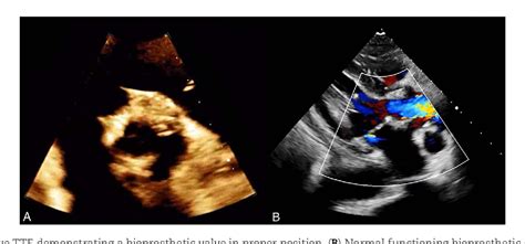Figure 3 From Aortic Root Abscess And Brucella Endocarditis In A