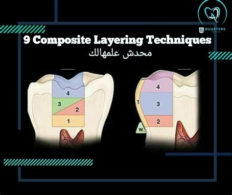 9 Composite Layering Techniques 5 Quarters Dentistry