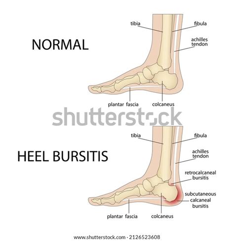 Subcutaneous Calcaneal Bursitis