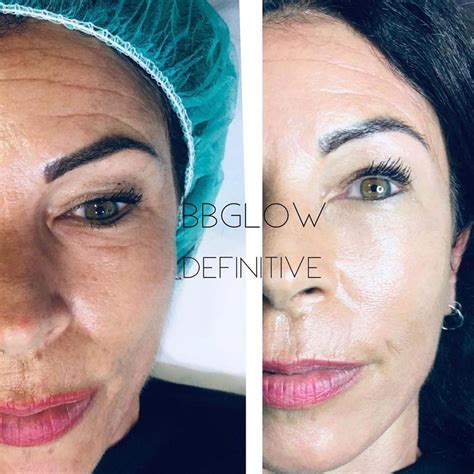 Bb Glow Before And After Pictures Gallery Best Examples