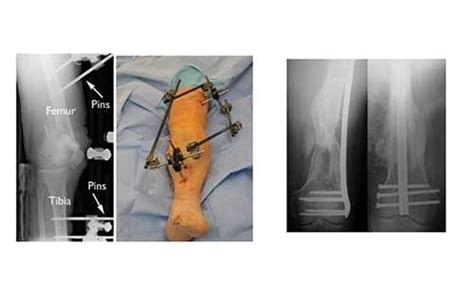 Fractures Of The Proximal End Of The Tibia Dr George Besiris