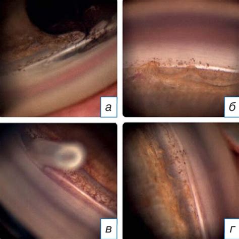Gonioscopy а Sinus Trabeculectomy б г Goniodysgenesis в Ahmed Download Scientific