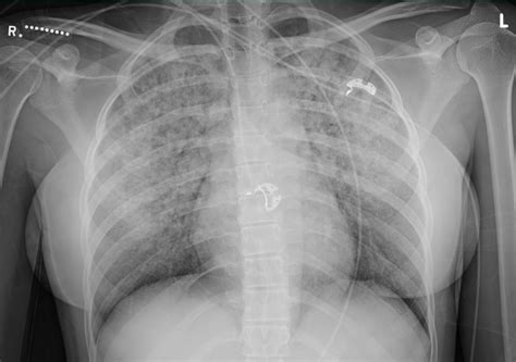 Vaporized Lung Shm Abstracts Society Of Hospital Medicine