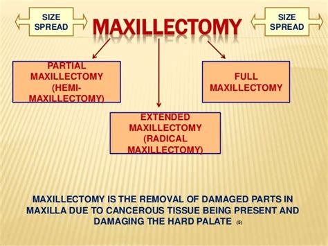 Maxillectomy