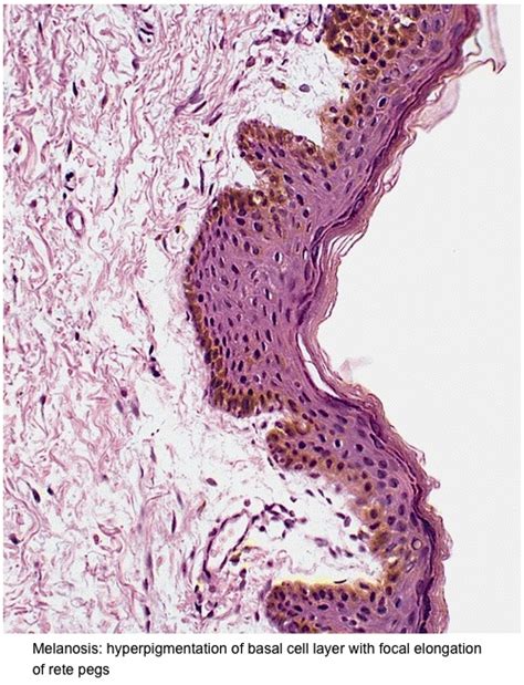 Pathology Outlines Melanosis And Lentiginosis