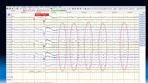 Normal Eeg Waveforms Pptx