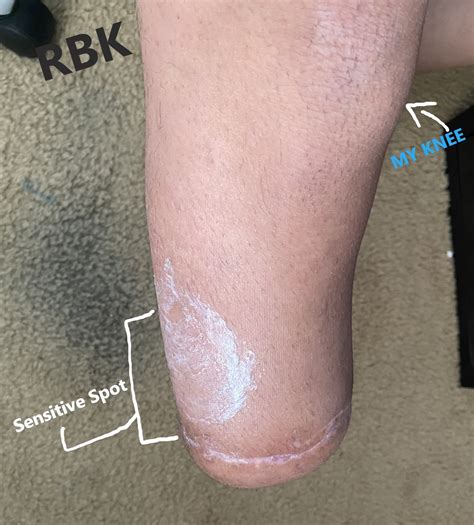 Has Anyone Had The Ertl Procedure Done And Has It Worked Im Worried About Possible Bone Poking