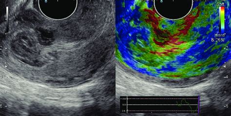 Submucosal Node Grayscale Mode And Compression Sonoelastography Mode Download Scientific