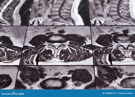 Mri Of A Patient With Intervertebral Disc Protrusion And Osteochondrosis Of The Thoracic Spine