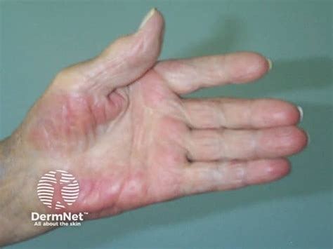 Erythema Hands