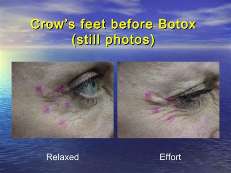 Botox Video Documentation Ppt