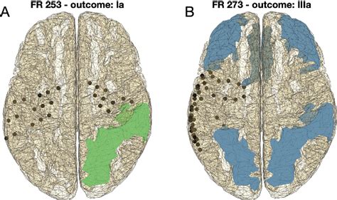 Figure 2 From Computational Modelling In Source Space From Scalp Eeg To