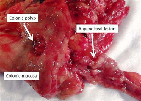 Appendiceal Adenocarcinoma Presenting As A Rectal Polyp Pmc