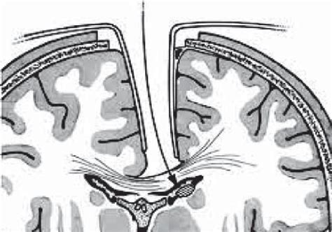 Picture Of Transcallosal Approach Download Scientific Diagram