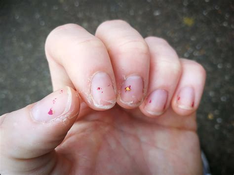 Why Are My Nail Beds Rough At Thomas Castillo Blog