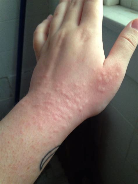 The Importance Of Patch Testing And Why You Really Need To Wait 24 48 Hours Before Declaring It