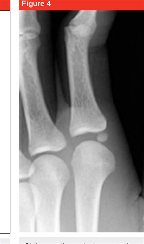 Figure 3 From Metacarpophalangeal Joint Dislocation Semantic Scholar