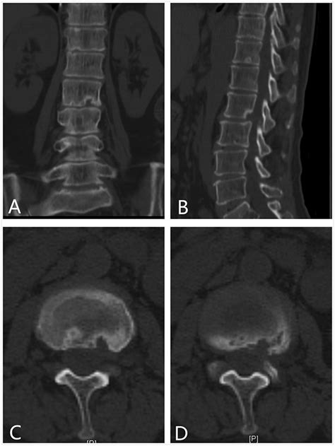 Treatment Of Painful One Level Schmorls Nodes Using Percutaneous Endo