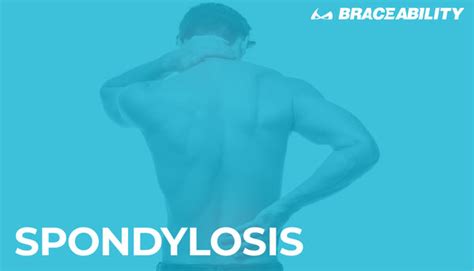 Spondylosis The Most Confusing Spine Condition Explained