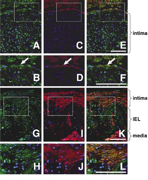 Patient 1 Double Fluorescence Immunohistochemical Staining Showing