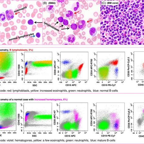 Morphologic And Immunophenotypic Features Of B Lymphoblasts With Download Scientific Diagram