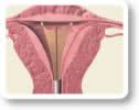 Ablation Procedures Women First Of Louisville