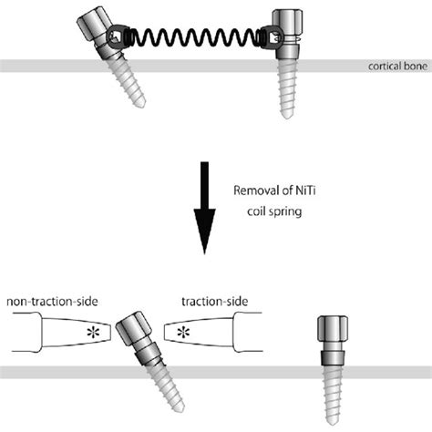 Method Of Mobility Measurement Using Periotest The Tip Of The