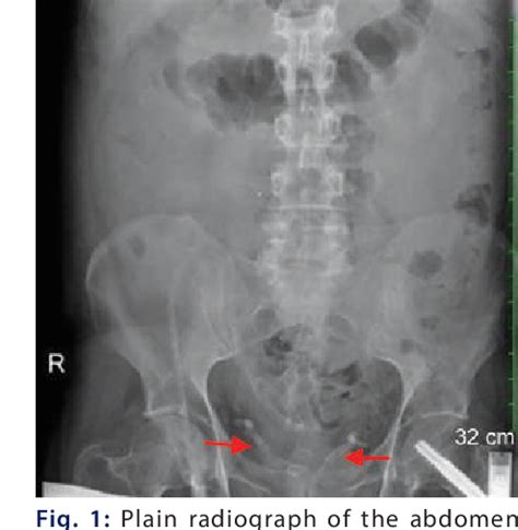 Figure 1 From Bilateral Calcification Of The Vas Deferens And The