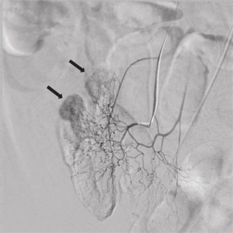 Active Bleeding From The Ileo Colic Artery Superselective Right Download Scientific Diagram
