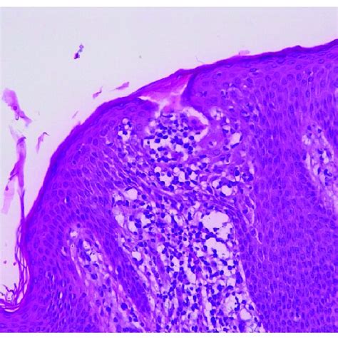 A Mycosis Fungoides Cd3 Ob ×20 B Mycosis Fungoides Cd4 Ob ×