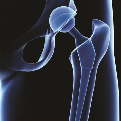 ენდოპროთეზირება ნიუ ჰოსპიტალსი