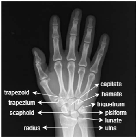 xrays of broken wrist