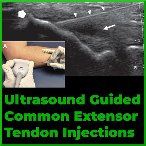 Lateral Epicondyle Injection