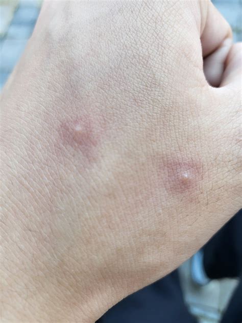 모기물린자국 지식in