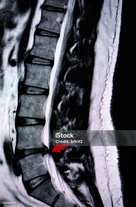 Mri Scan Of Lateral Lumbar Vertebral Column Showing L4l5 Disc