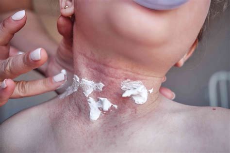 Atopic Dermatitis Vs Eczema How Do They Differ