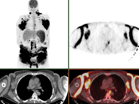 Characterization Of T Cell Lymphomas By Fdg Petct Ajr