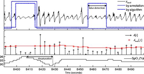 Example Of Hypopnea Detection Using Our Proposed Algorithm Download Scientific Diagram