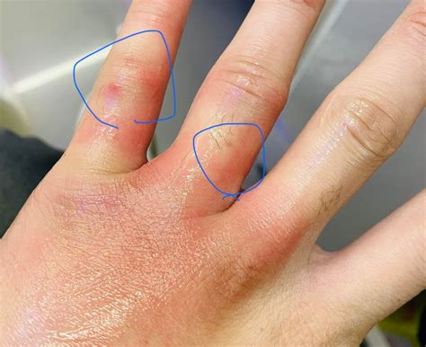 손 붓기 질문 지식in