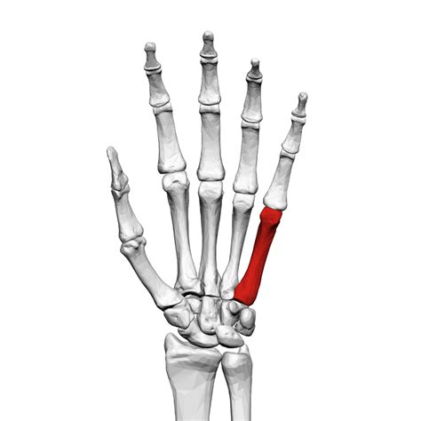 Fifth Metacarpal Shaft Fracture Rxharun