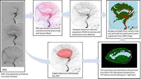 Overview Of Image Segmentation Approach In A Patient With M1 Occlusion Download Scientific